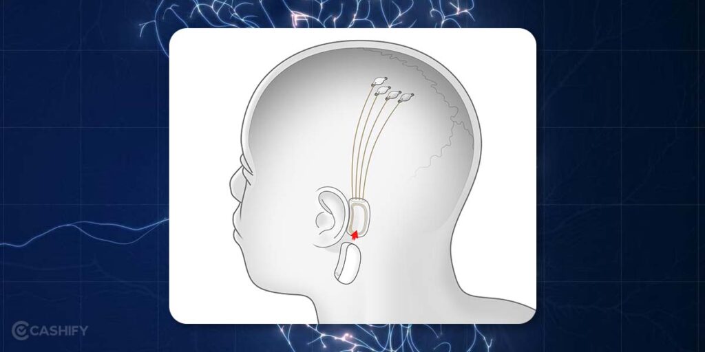 What Is Neuralink? Top Facts About Elon Musk’s Technology On Brain ...